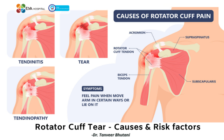 Rotator Cuff tear - Causes & Risk factors - Eva Hospital Rotator Cuff tear - Causes & Risk factors - Eva Hospital