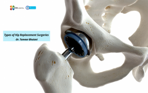 Types of Hip Replacement Surgeries - Eva Hospital