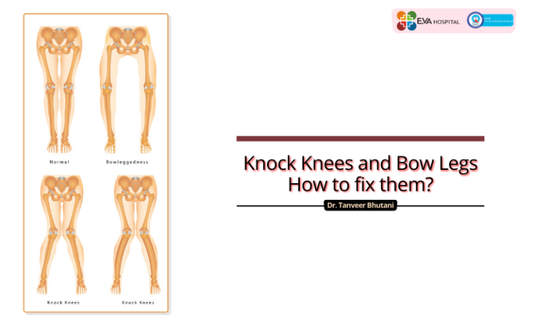 Knock Knees and Bow Legs - How to fix them?